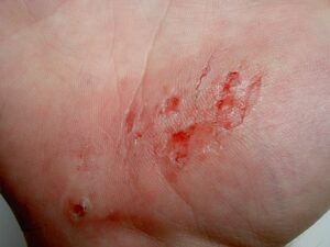 Excoriation vs. Abrasion: What's the Difference? - Main Difference