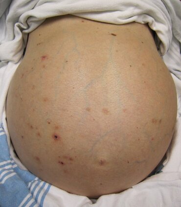 Ascites vs. Anasarca: What's the Difference? - Main Difference