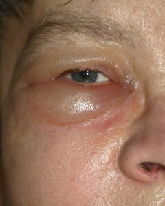Oedema vs. Edema: What's the Difference? - Main Difference